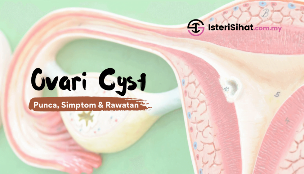 Ovari Cyst - Punca, Simptom dan Rawatan